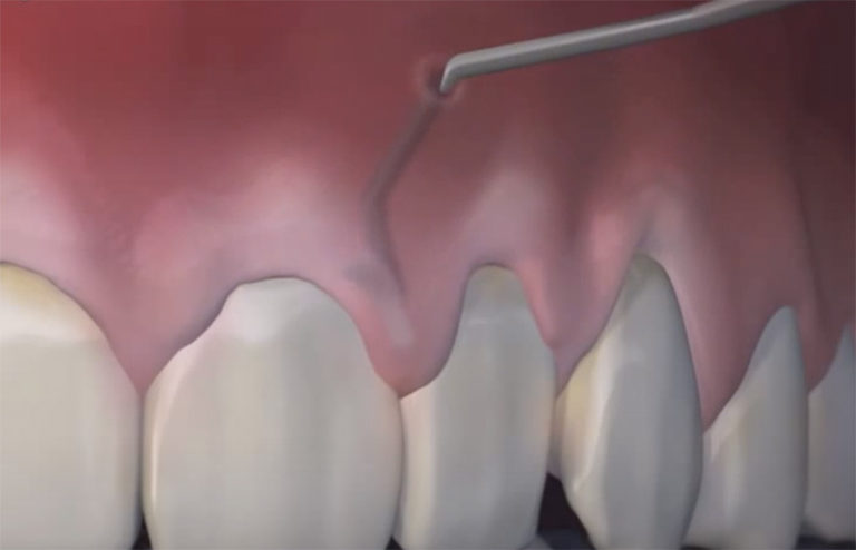 Pinhole® Surgical Technique | Salem, NH | Dr. Charles Burliss